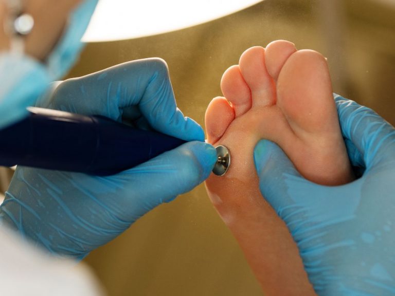 Callos en los Pies: Causas, Tipos, Tratamientos y Prevención